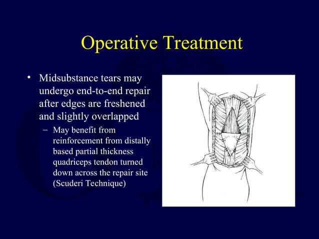Patella Fractures & Extensor Mechanism Injuries.ppt