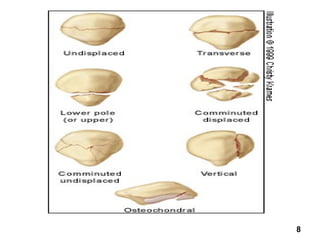 Patellar Anatomy , deformity and management .ppt