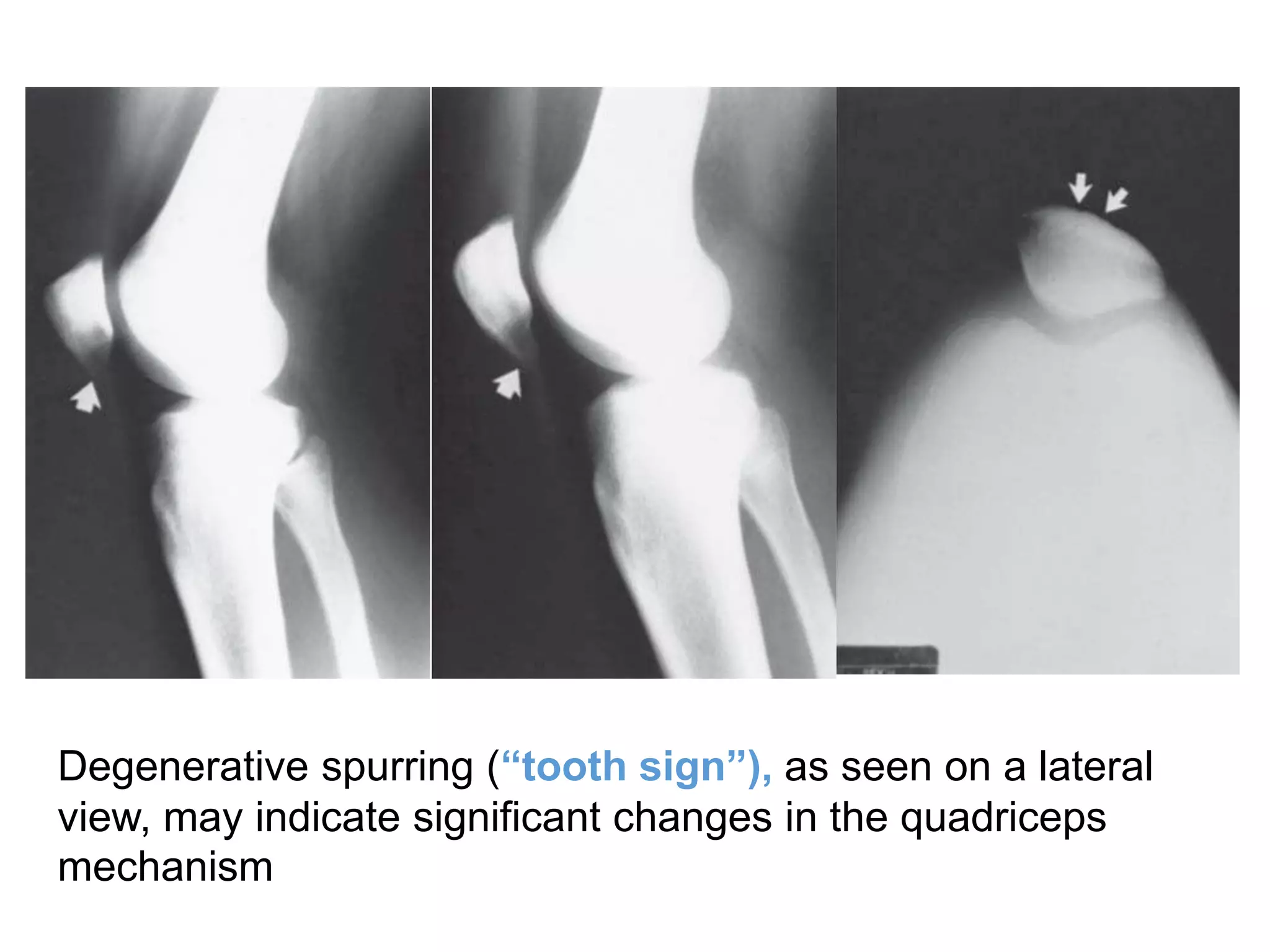 Patellar and quadriceps tendon rupture | PPTX