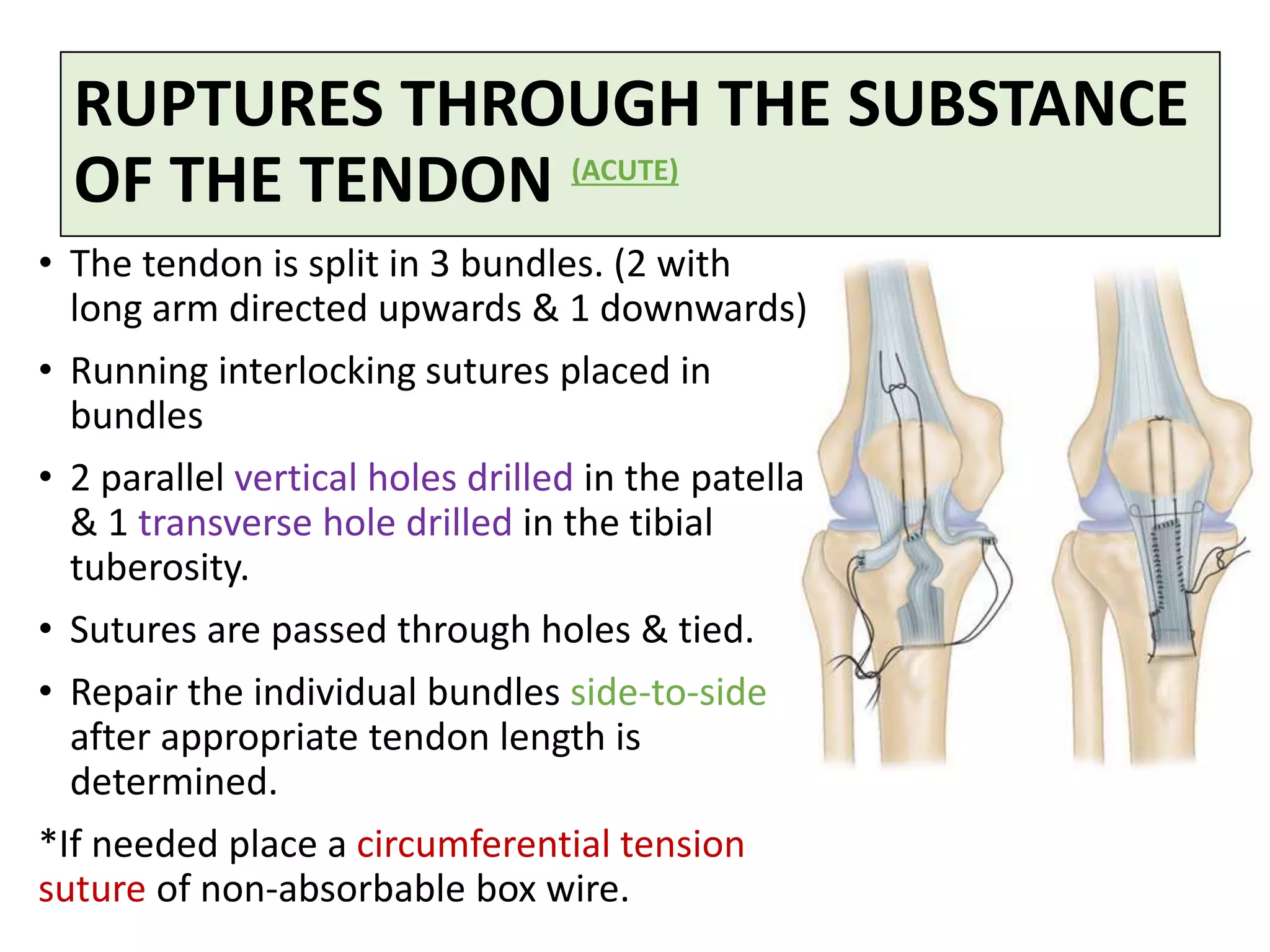 Patellar and quadriceps tendon rupture | PPTX