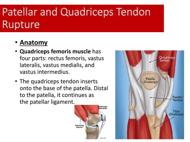 Patellar and quadriceps tendon rupture | PPTX | Death, Injury, or ...