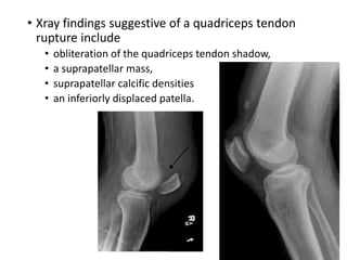 Quadriceps Tendon Calcification