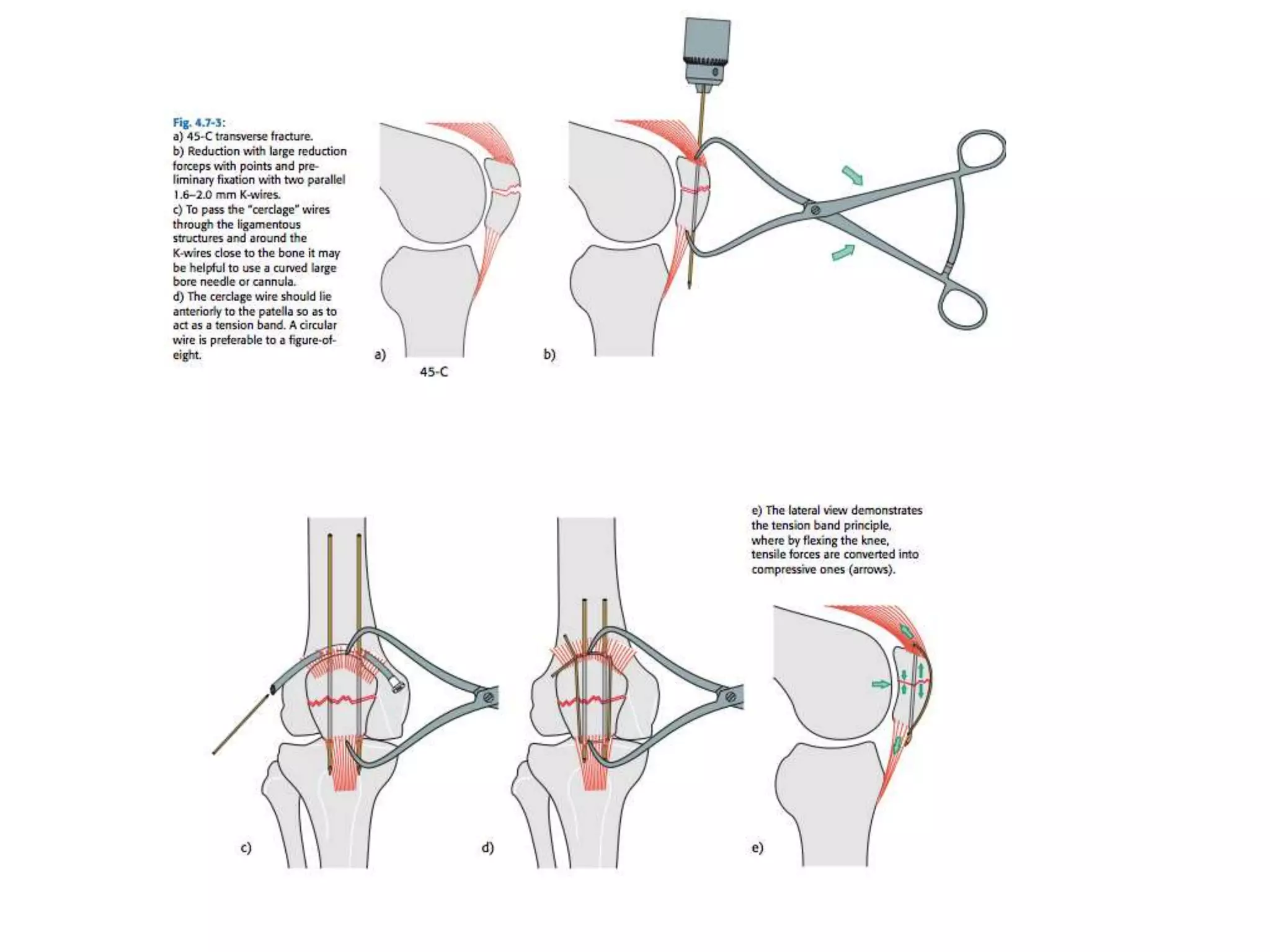 patellar fracture.pptx