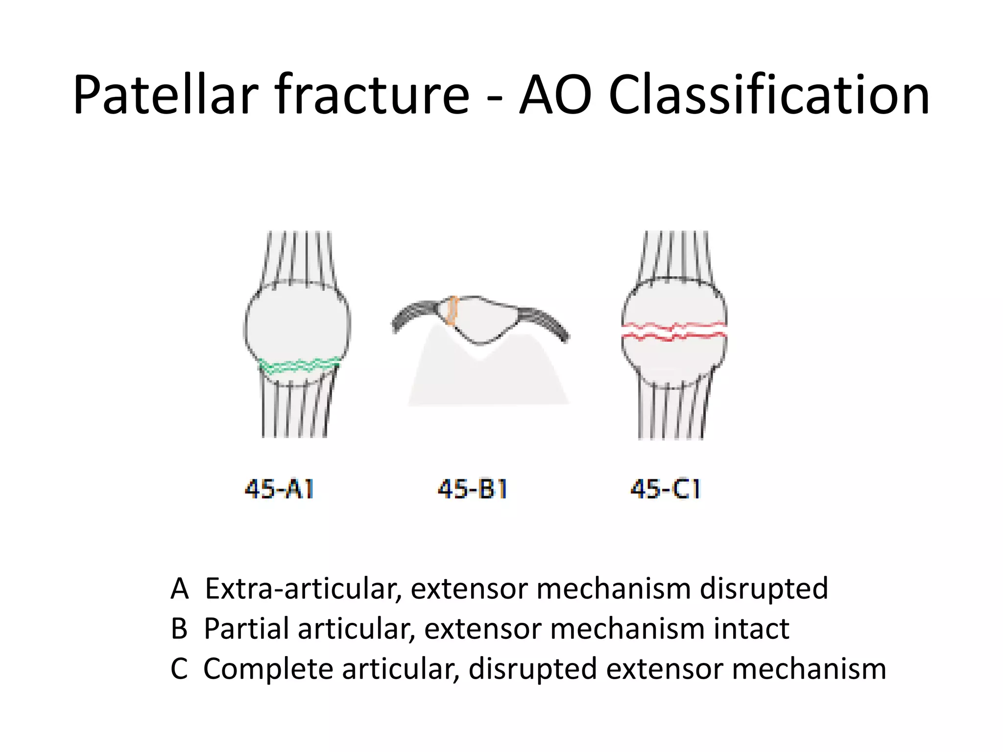 patellar fracture.pptx