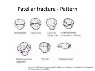 patellar fracture.pptx
