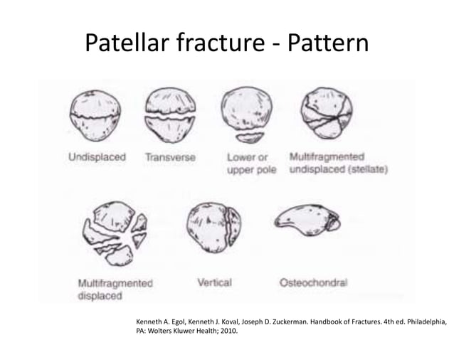 patellar fracture.pptx