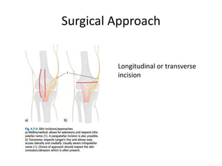 patellar fracture.pptx