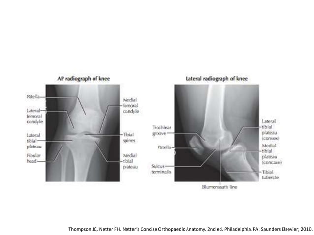 patellar fracture.pptx