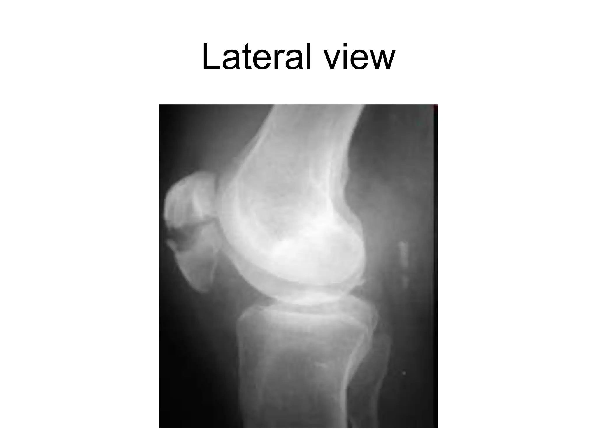 patellar fracture.ppt. . | PPT