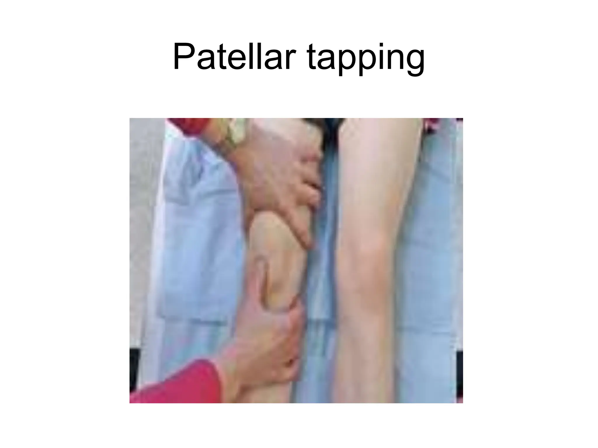patellar fracture.ppt. . | PPT