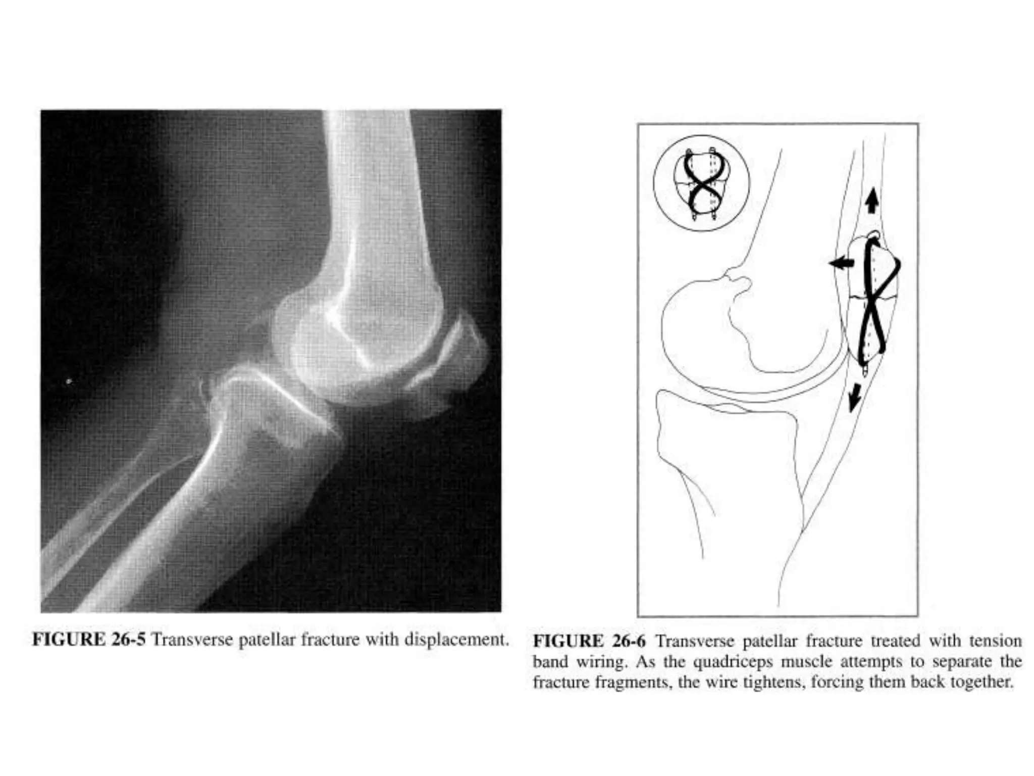 Patellar fractures & Physiotherapy | PPTX