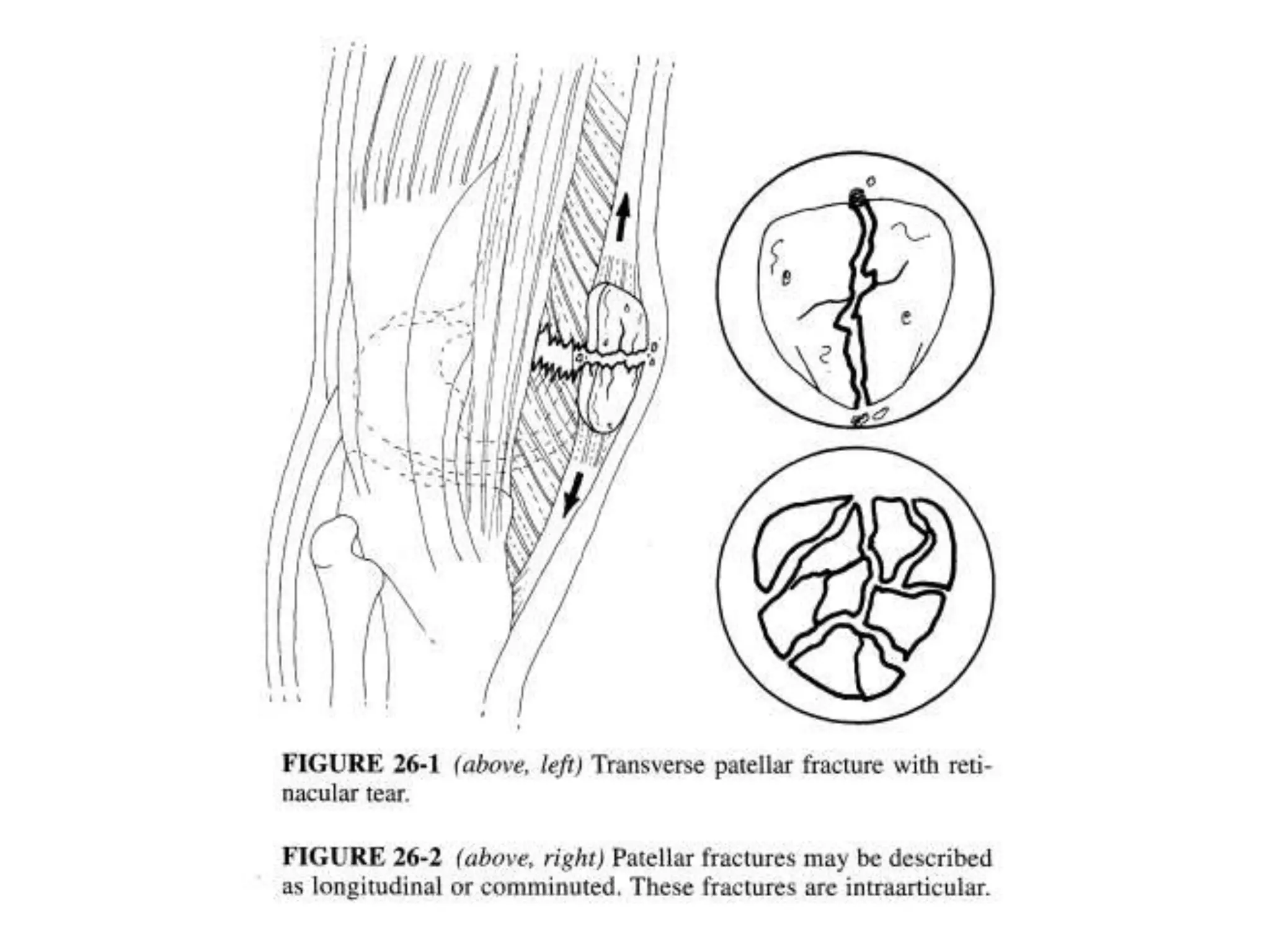 Patellar fractures & Physiotherapy | PPTX