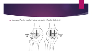 Recurrent Patellar instability | PPTX
