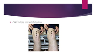 Recurrent Patellar instability | PPTX