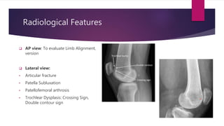 Recurrent Patellar instability | PPTX