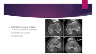 Recurrent Patellar instability | PPTX