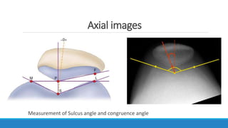 Patellar Instability | PPTX