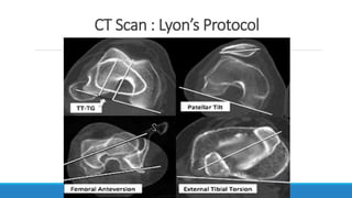 Patellar Instability | PPTX