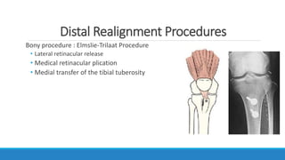 Patellar Instability | PPTX