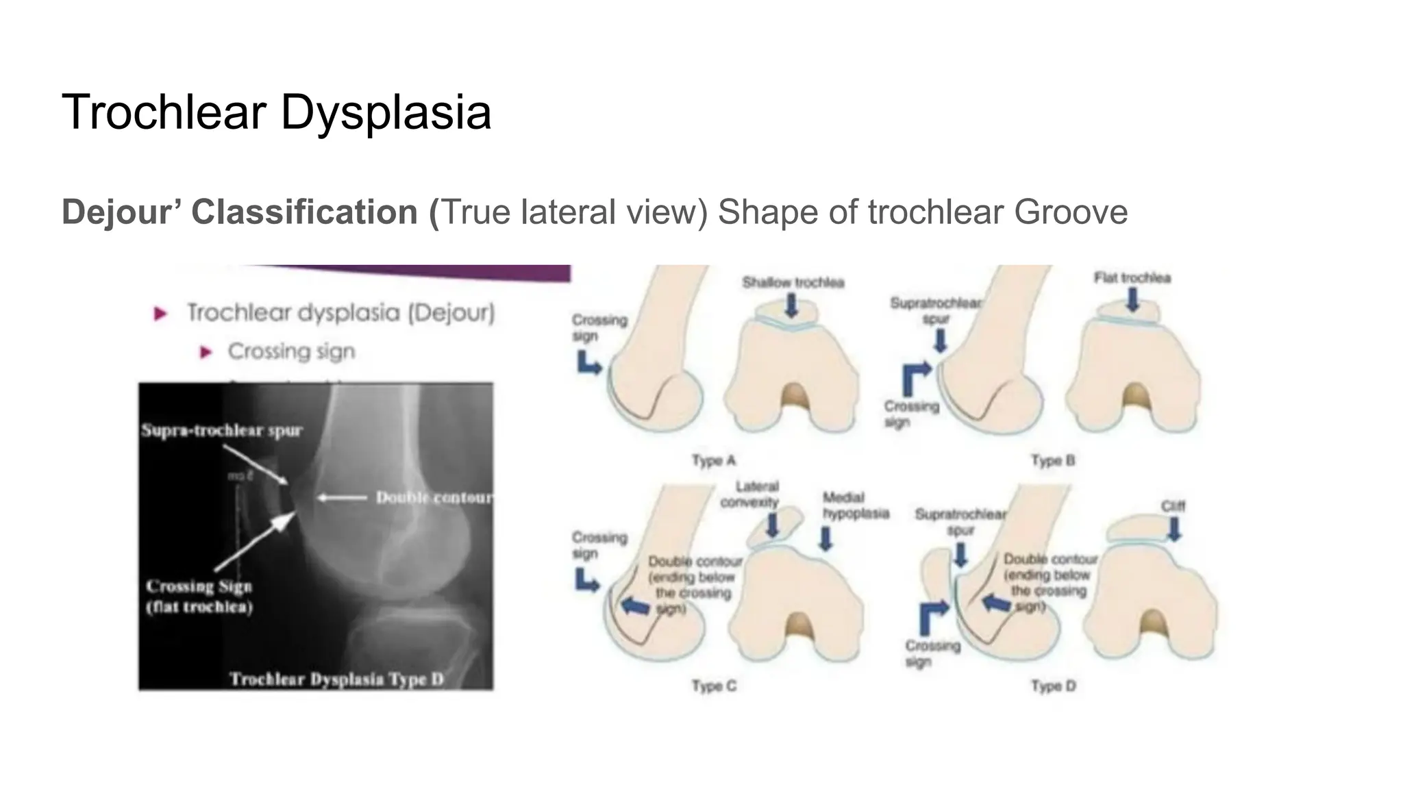 Patellar Instability: Diagnosis Management | PDF