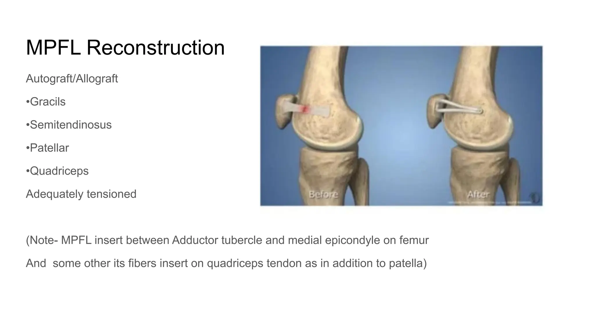 Patellar Instability: Diagnosis Management | PDF