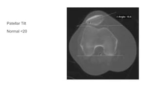 Patellar Instability: Diagnosis Management | PDF