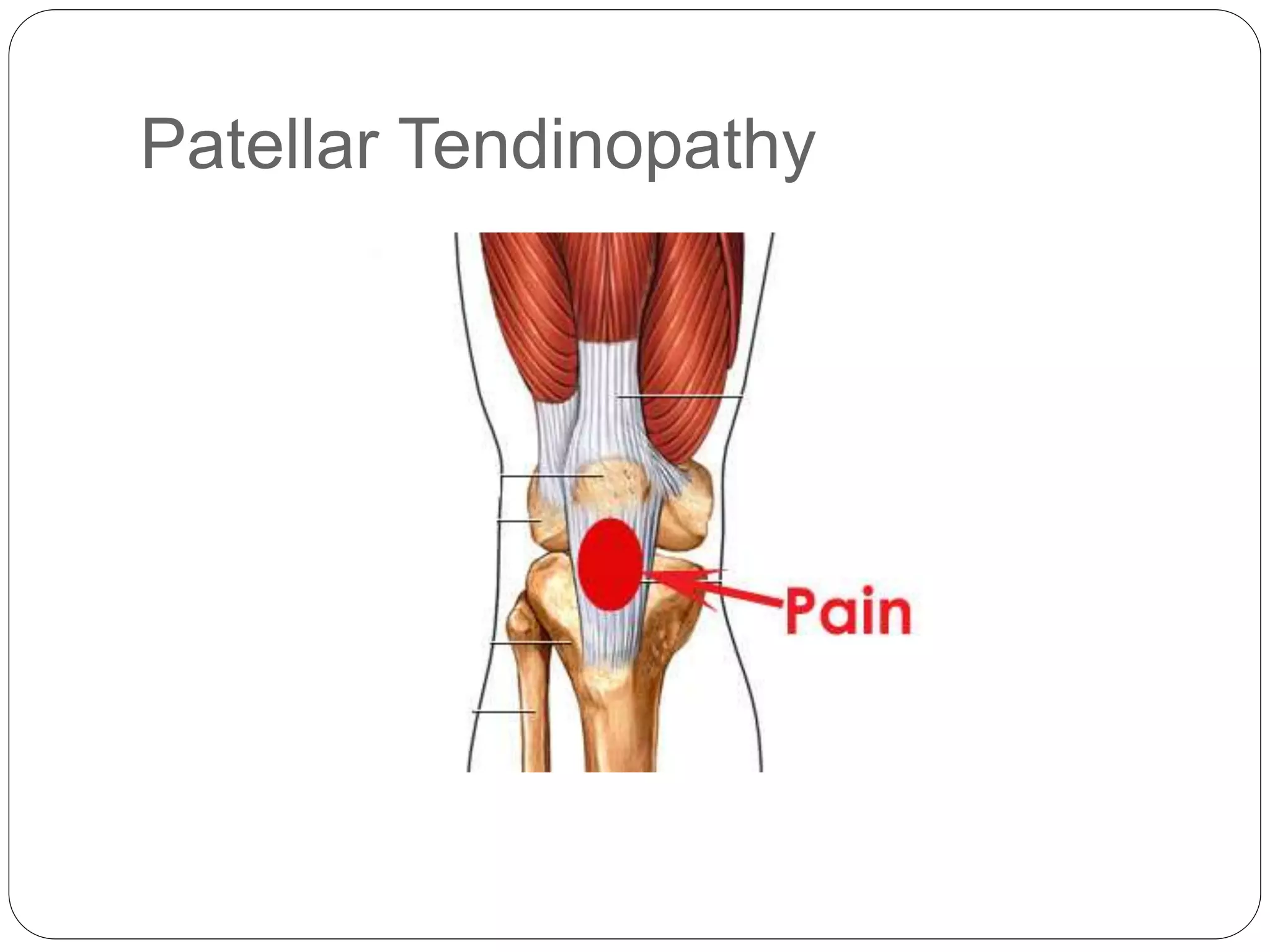 Patellar tendinopathy | PPTX