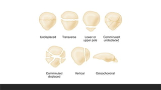 Presentation Title: Patellectomy – Anatomy, Biomechanics, Management ...