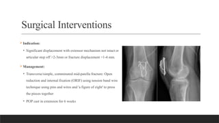 Presentation Title: Patellectomy – Anatomy, Biomechanics, Management ...