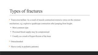Presentation Title: Patellectomy – Anatomy, Biomechanics, Management ...