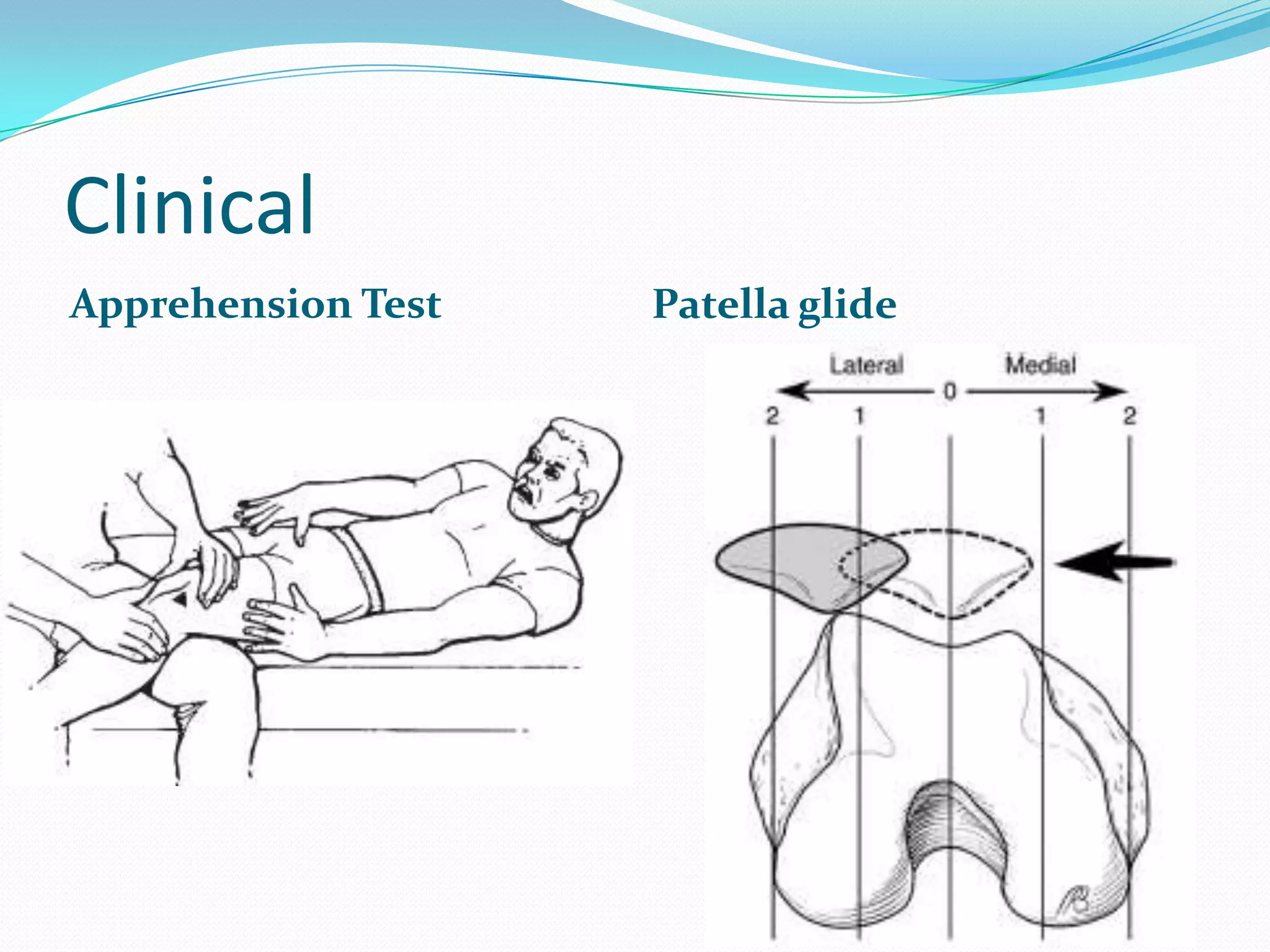 Patello femoral instability | PPTX