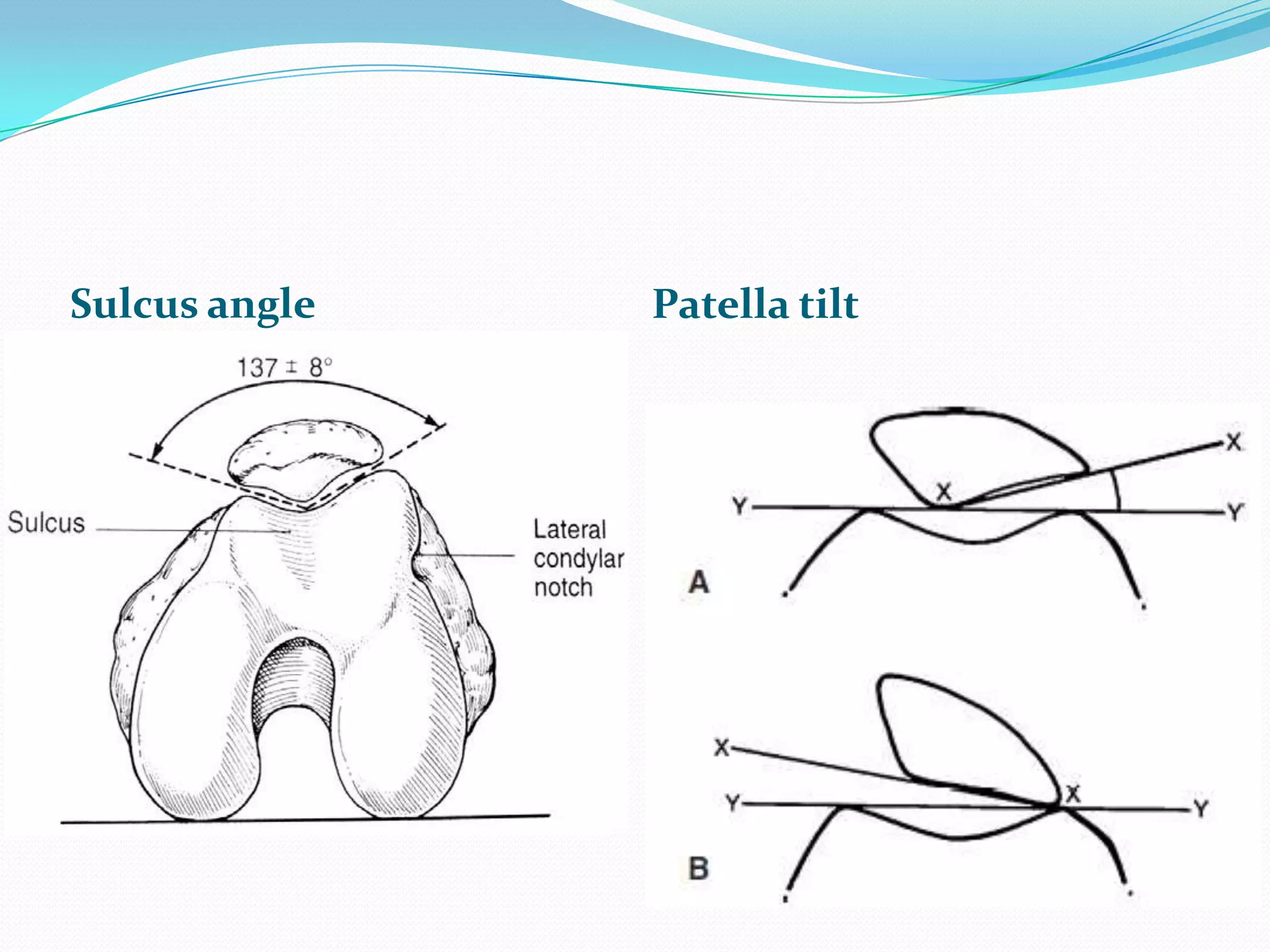 Patello femoral instability | PPTX
