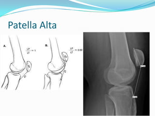 Patello femoral instability | PPTX