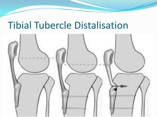 Patello femoral instability | PPTX
