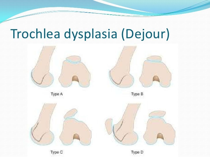 Patello femoral instability