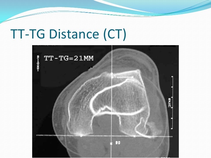 Patello femoral instability