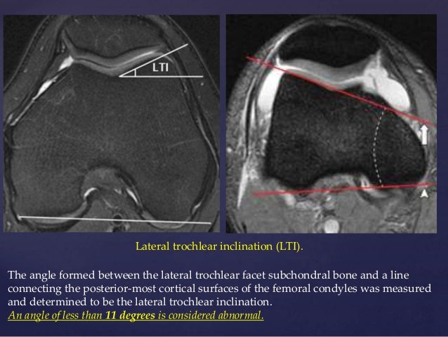 Patello femoral jt.