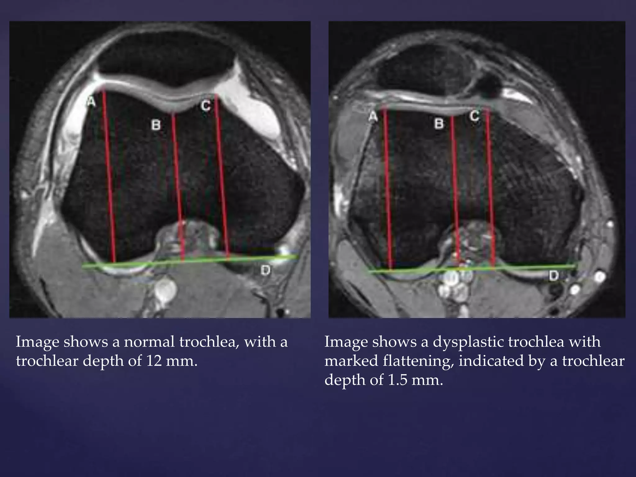 Patello Femoral Joint Mri Pptx