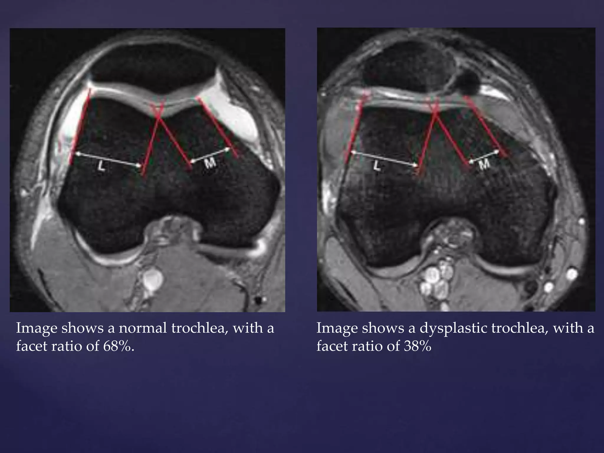 Patello femoral joint - MRI | PPTX