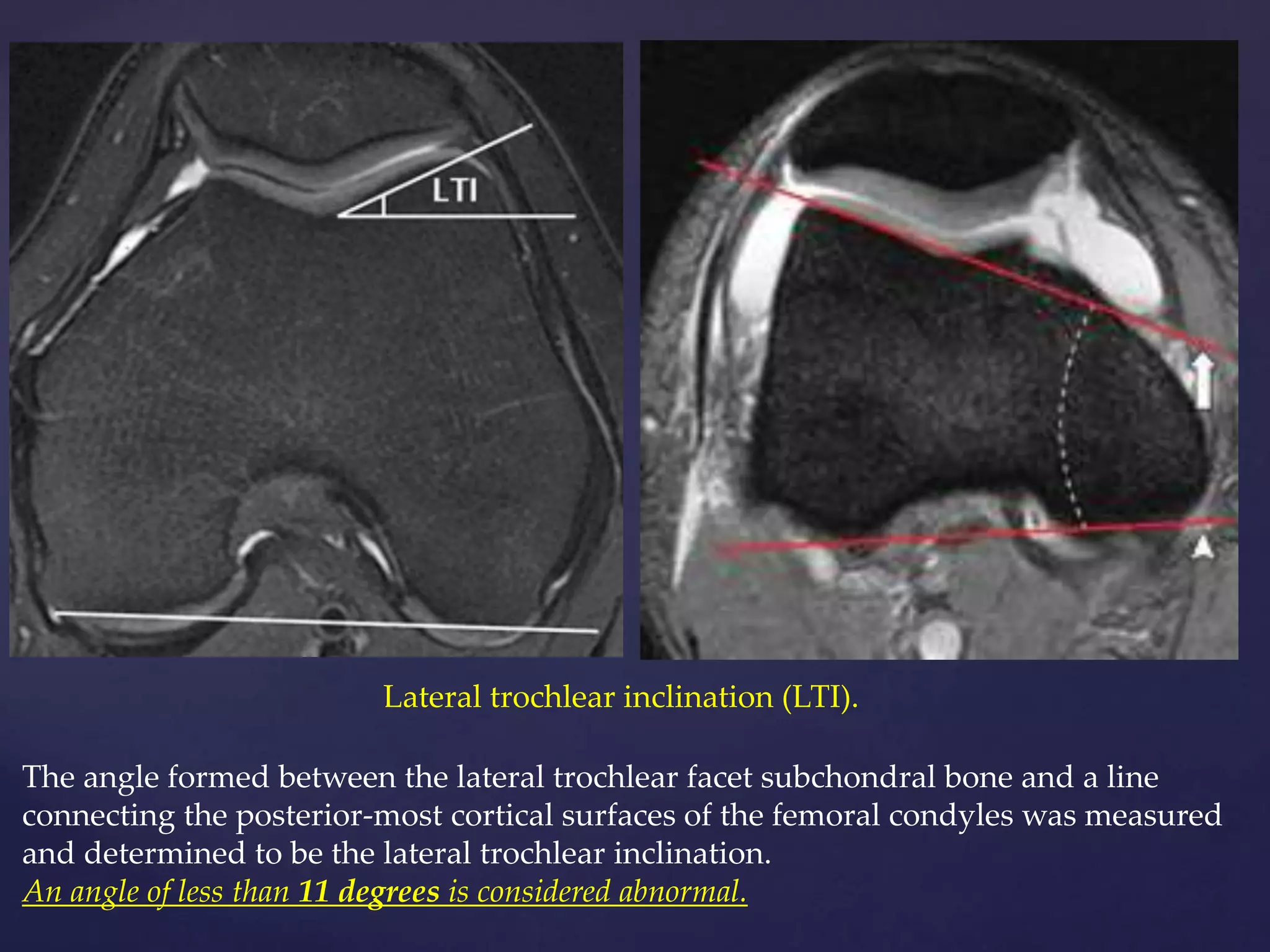 Patello femoral joint - MRI | PPTX