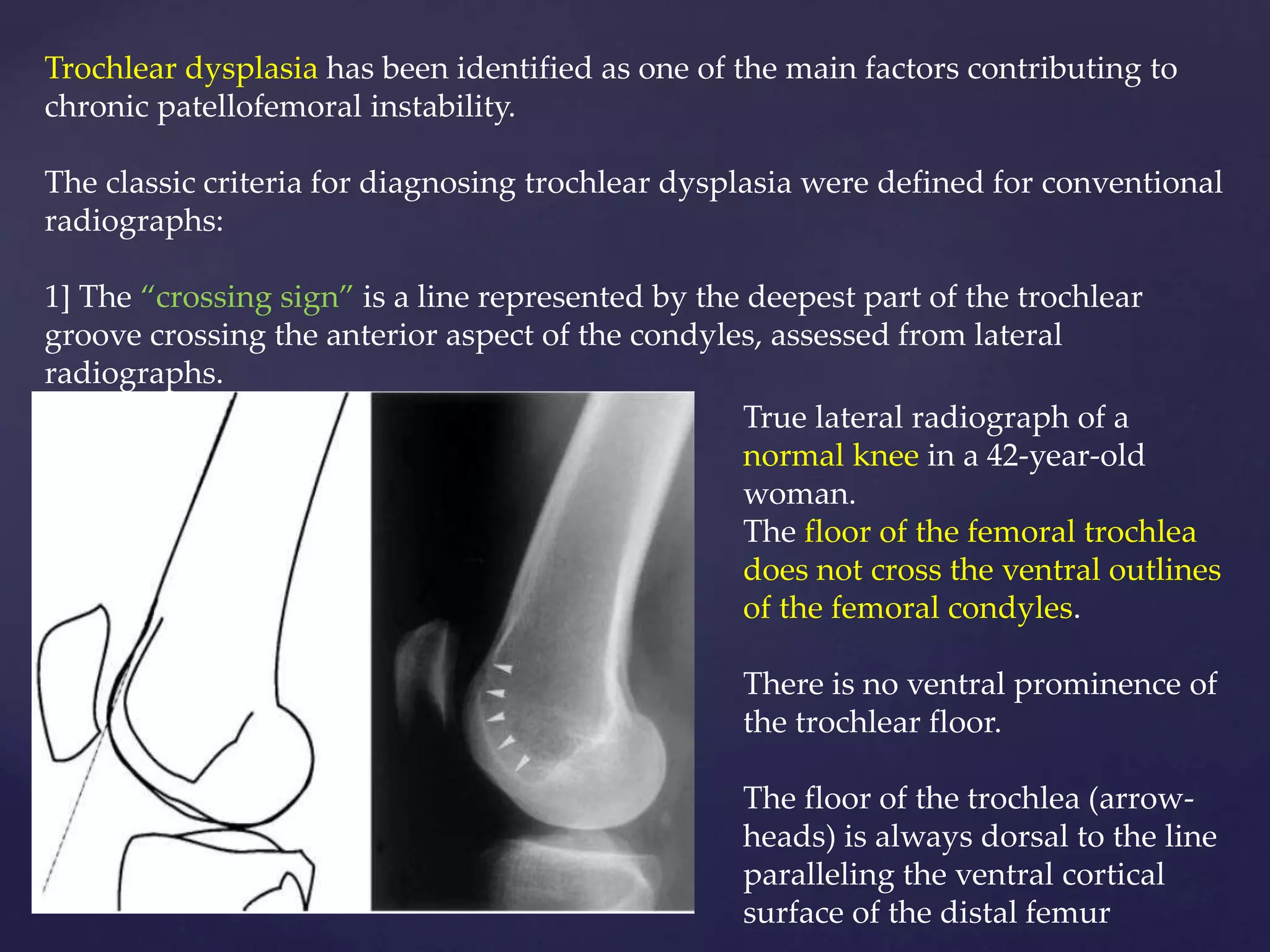 Patello femoral joint - MRI | PPTX
