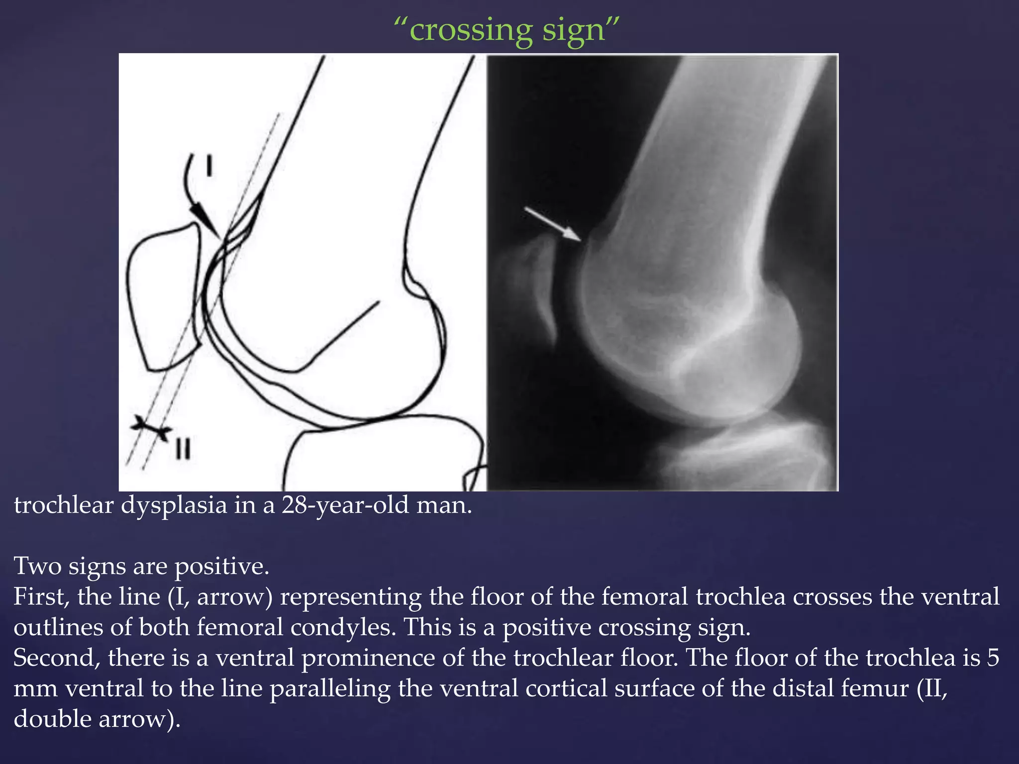 Patello femoral joint - MRI | PPTX