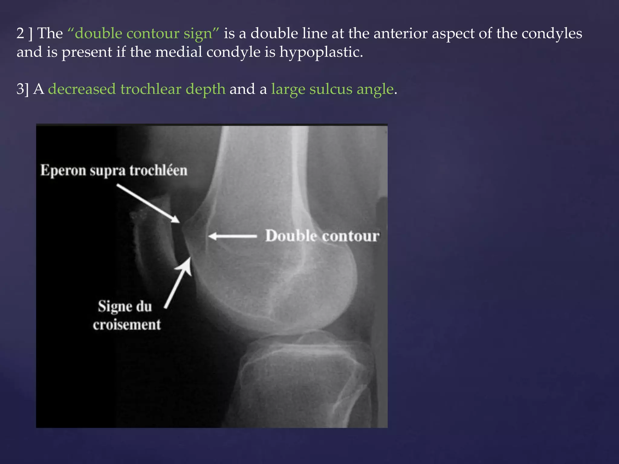 Patello femoral joint - MRI | PPTX