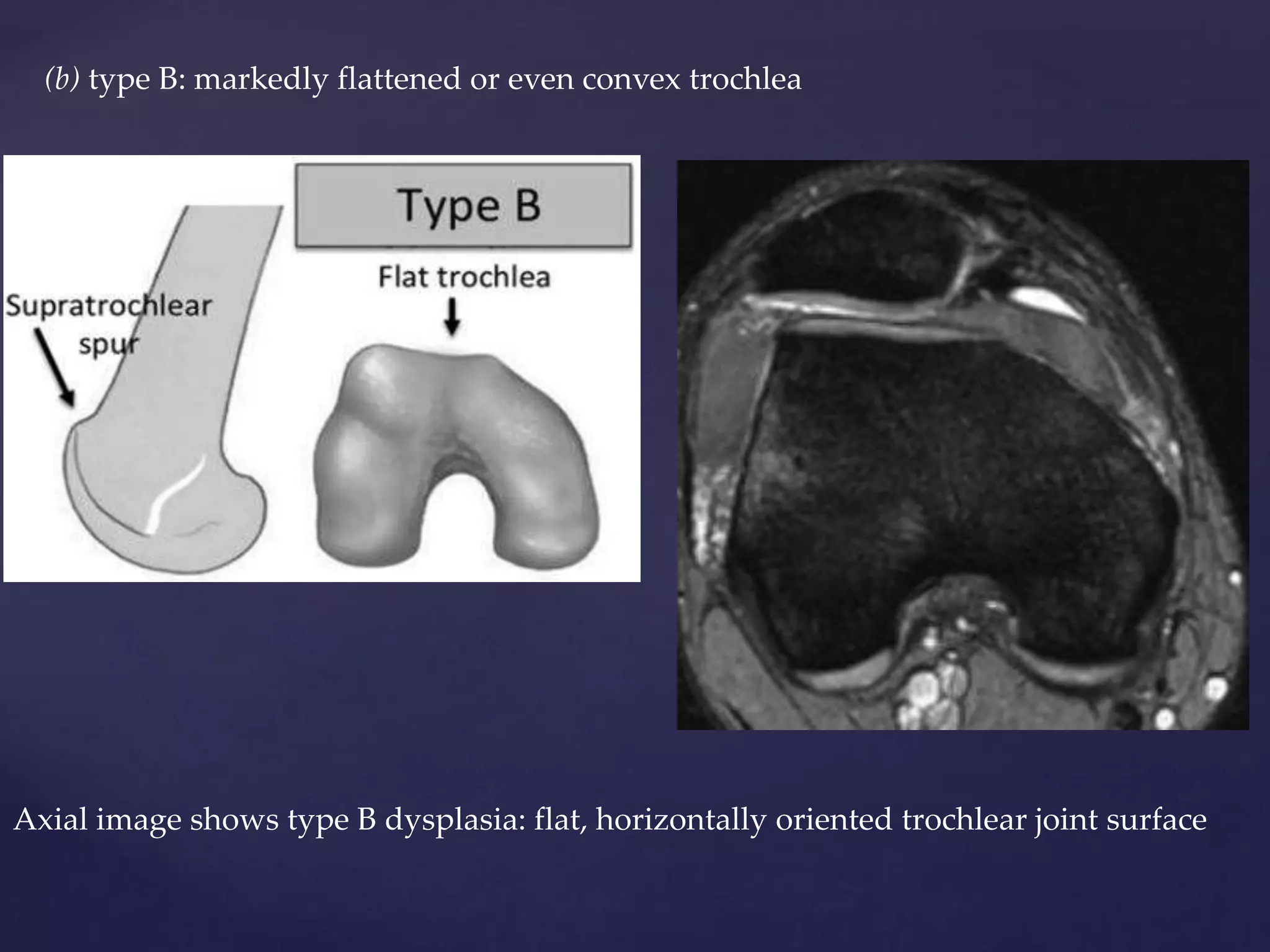 Patello femoral joint - MRI | PPTX