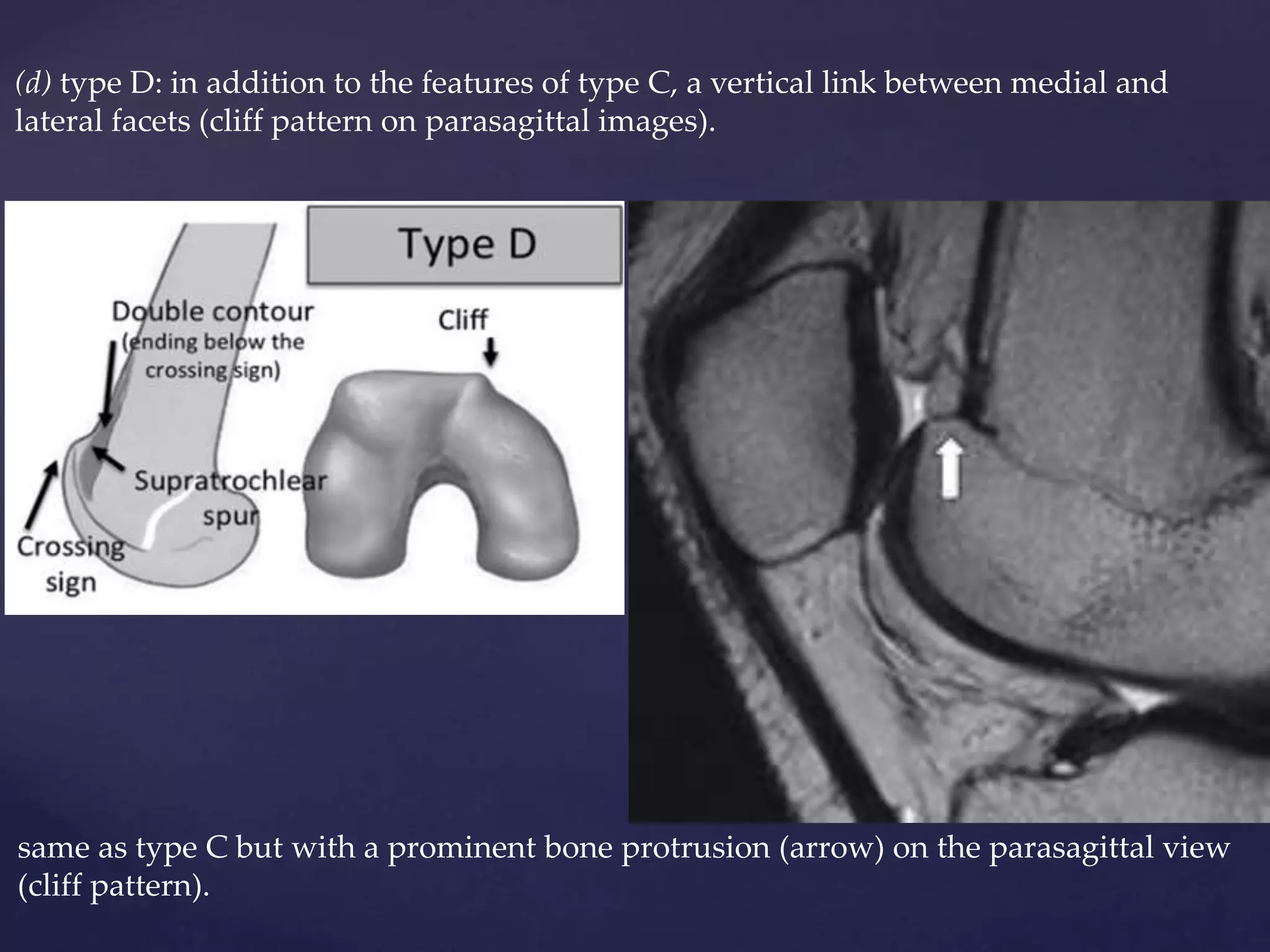 Patello femoral joint - MRI | PPTX