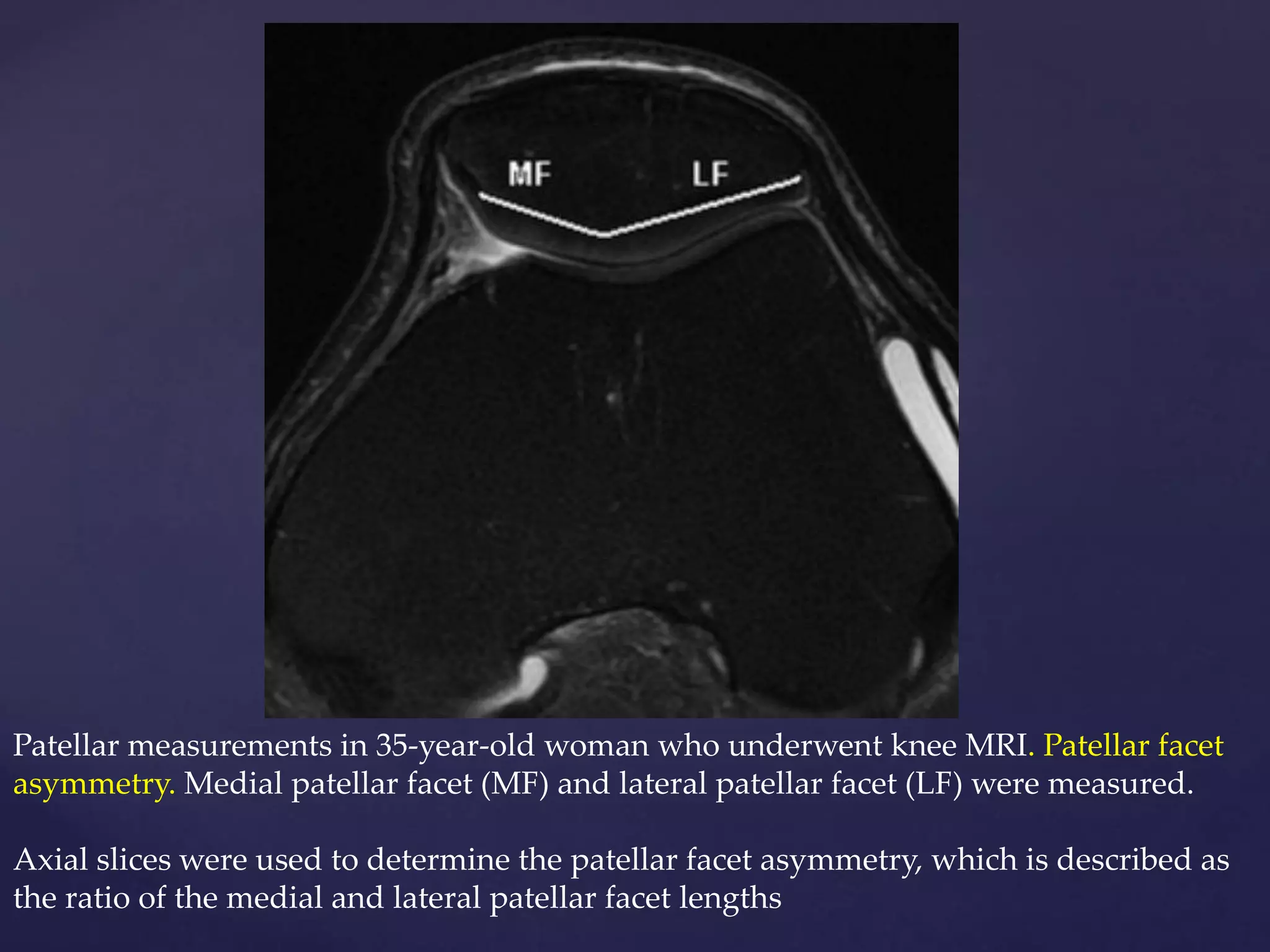 Patello femoral joint - MRI | PPTX