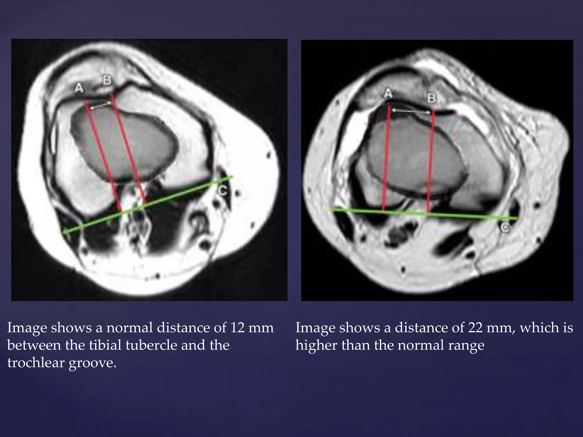 Patello femoral joint - MRI | PPTX
