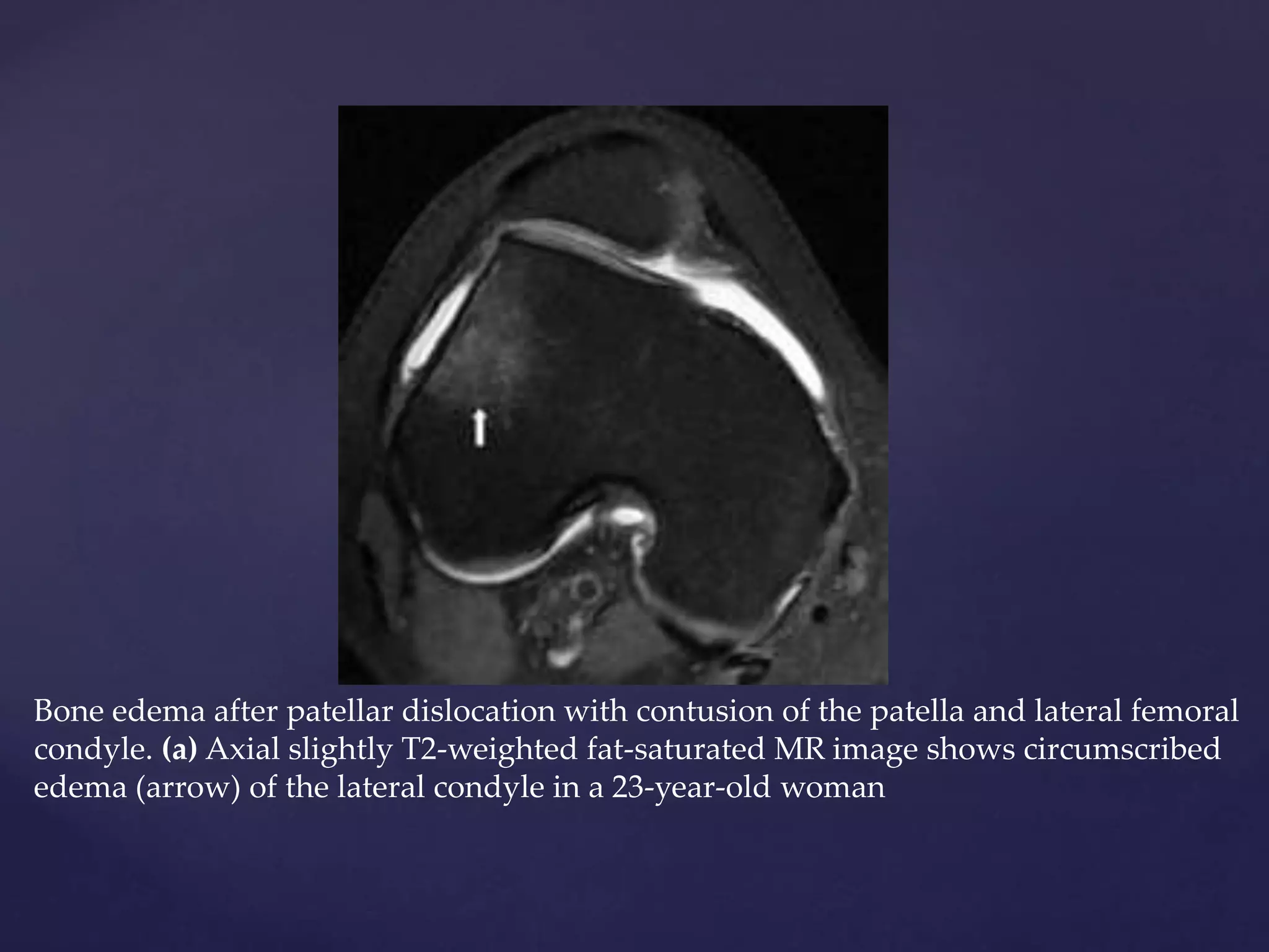 Patello femoral joint - MRI | PPTX