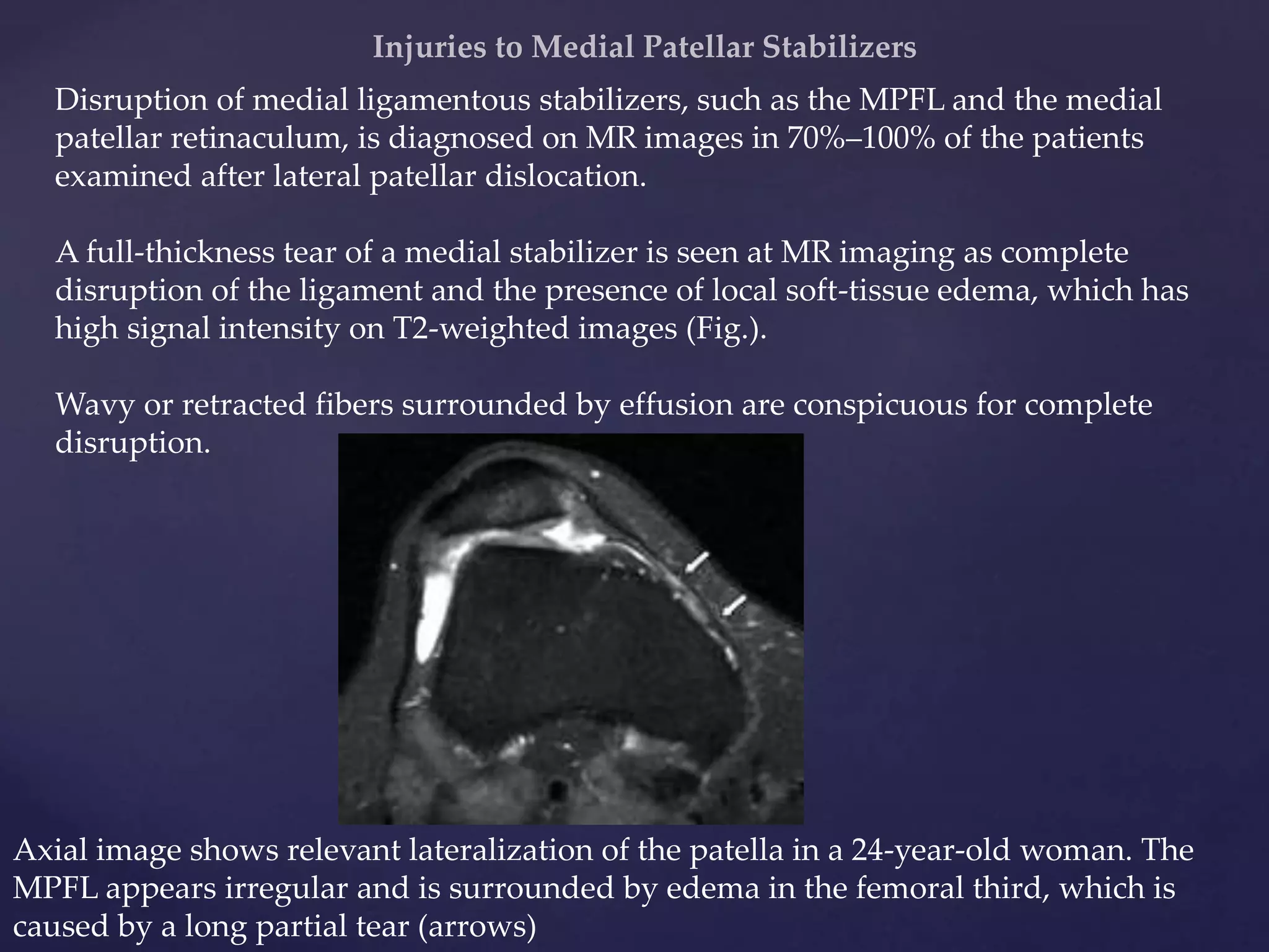 Patello femoral joint - MRI | PPTX