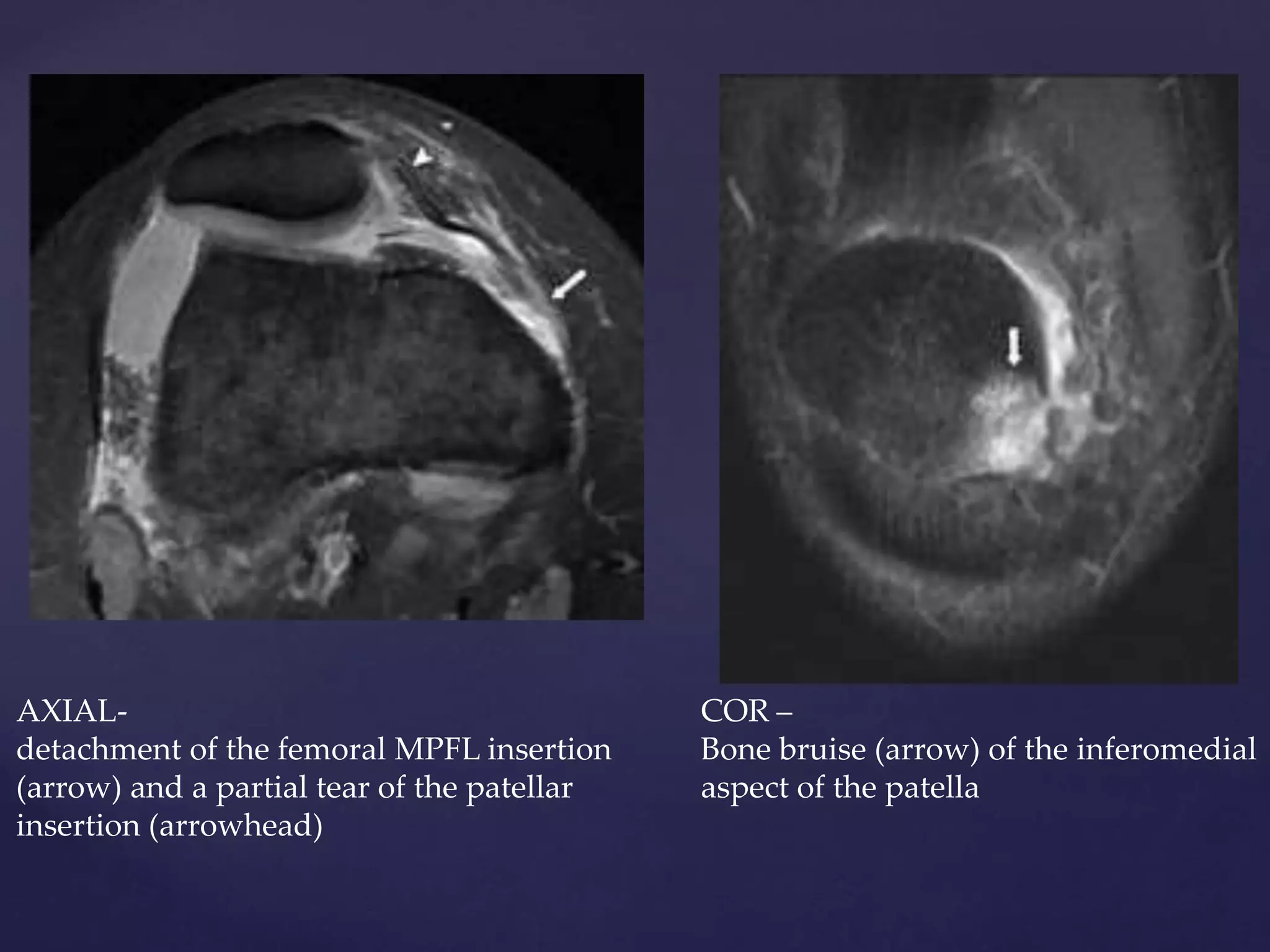 Patello femoral joint - MRI | PPTX